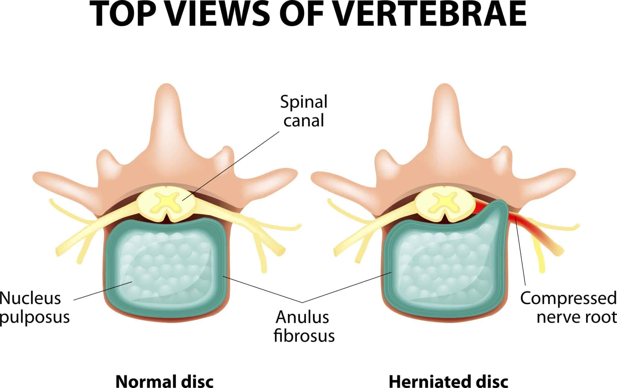 Lumbar Disc Prolapse Treatement St Pauls